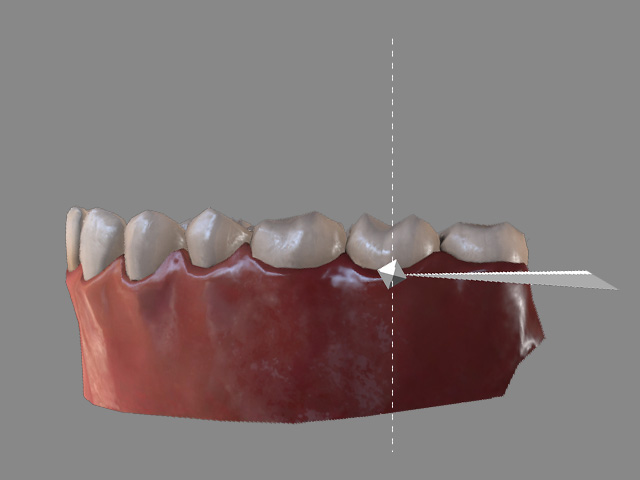 Optimal Teeth Bone Position