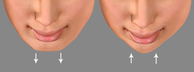 Fitting Chin and Jaw Contour