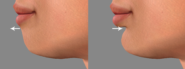 Fitting Chin and Jaw Contour