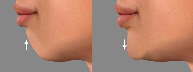 Fitting Chin and Jaw Contour